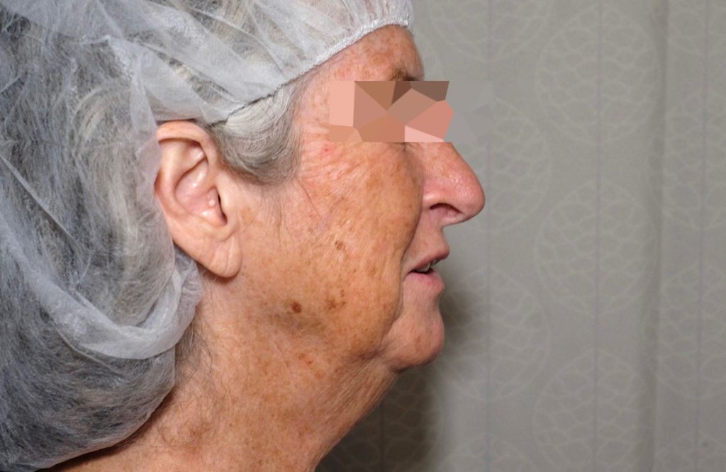 Face Before/After Gallery - Fine Cosmetic Surgery